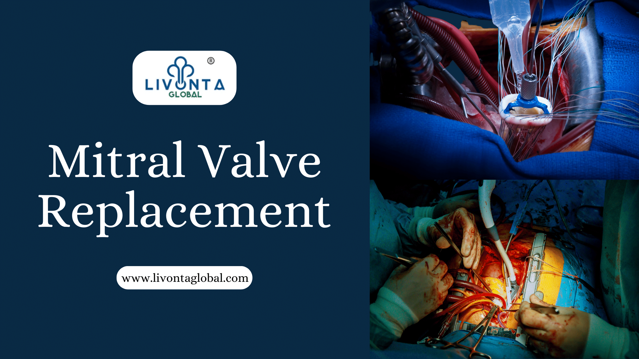 Mitral Valve Replacement Livonta Global Pvt Ltd Mitral Valve Replacement Livonta Global Pvt Ltd